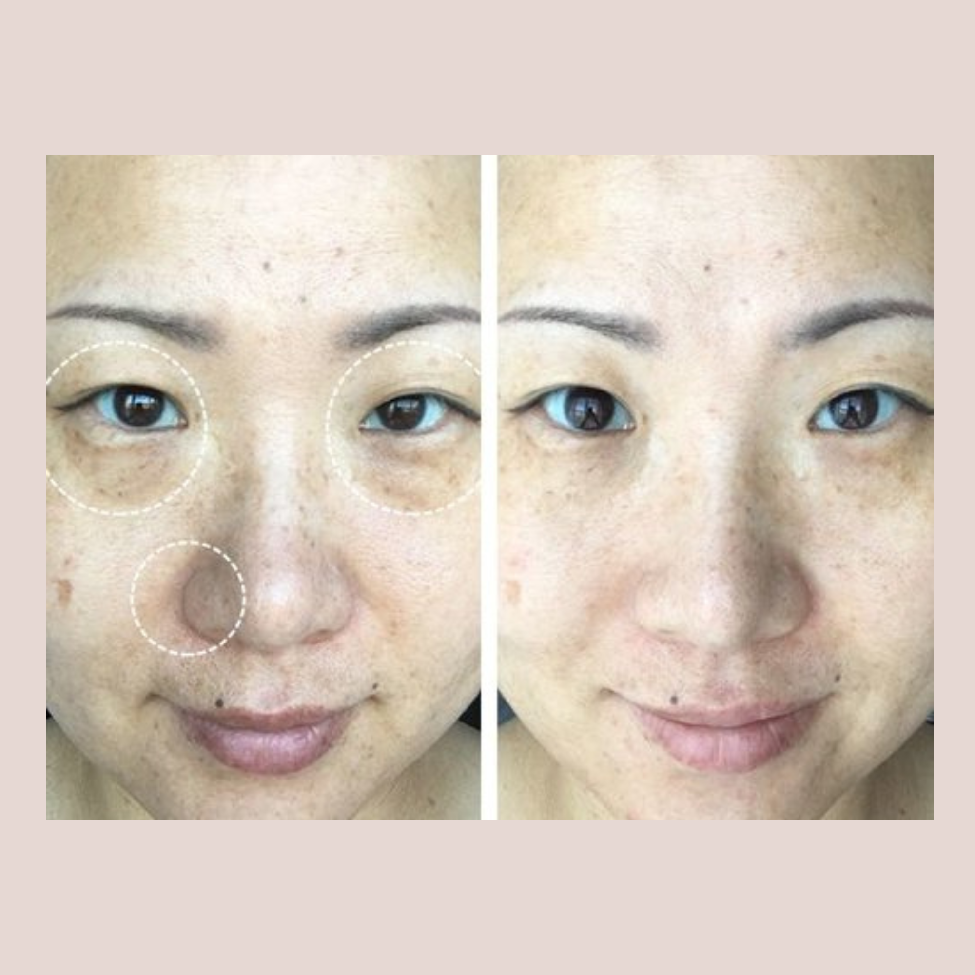 Before & Afters – EVER Skincare