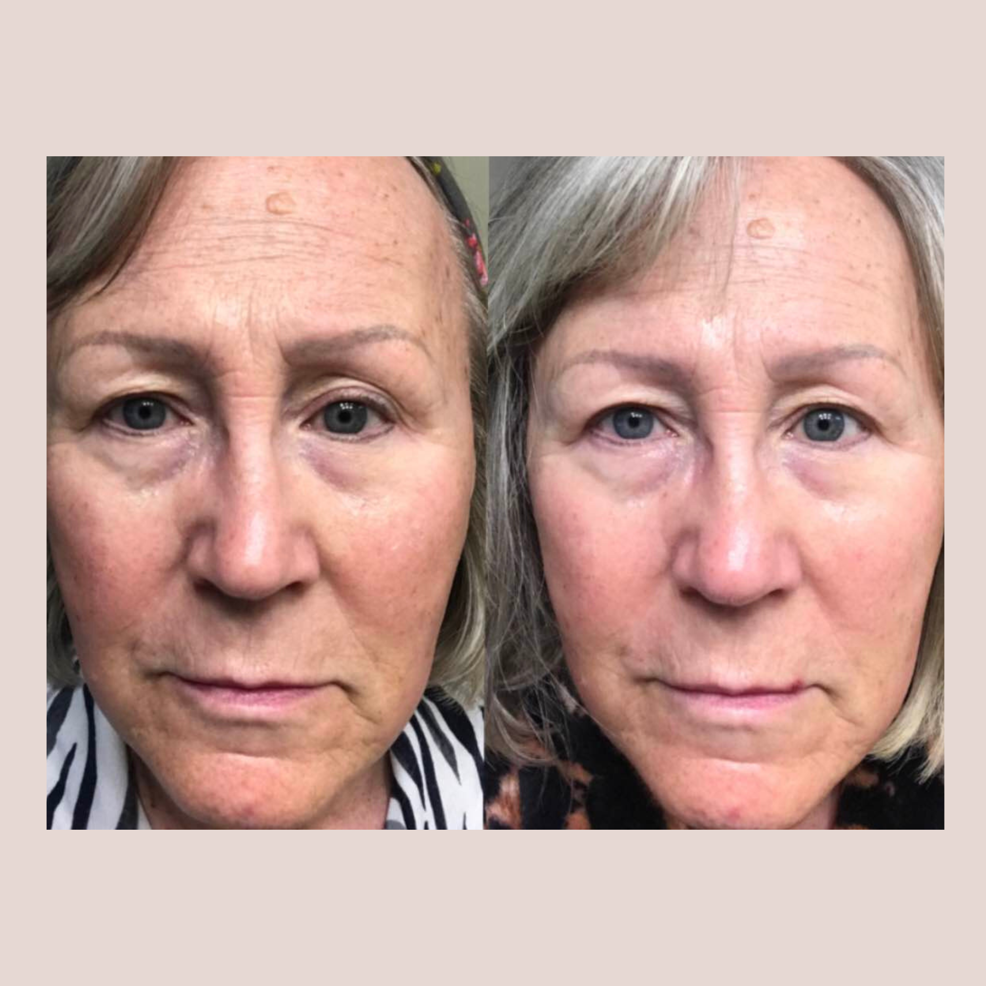 Before & Afters – EVER Skincare